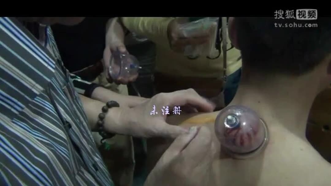王本正放血大椎穴拔罐放血操作