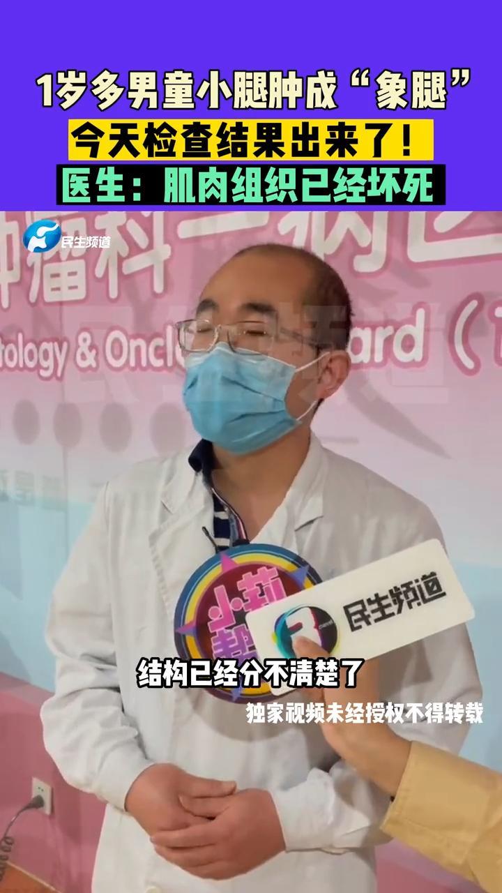 ...成"象腿" ,今天检查结果出来了!医生:肌肉组织已经坏死 #河南dou知道