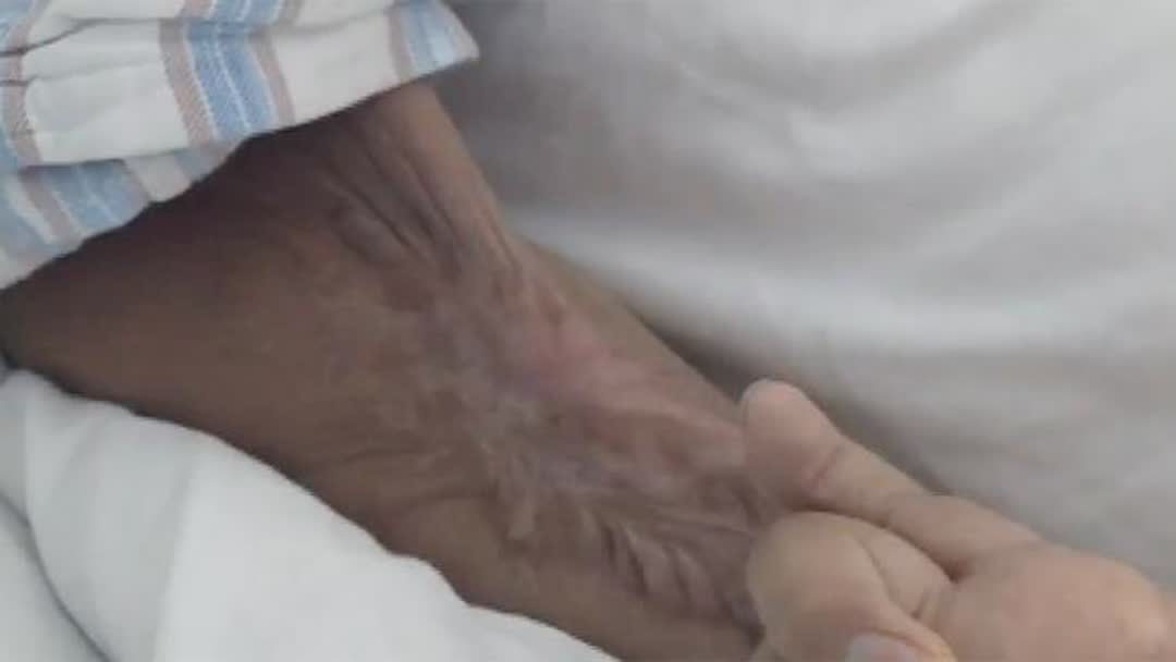 烧伤、烫伤出现的瘢痕增生能用激光有效去除吗?听听专业分析