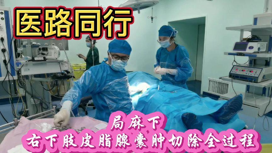 局麻下 皮脂腺囊肿切除全过程