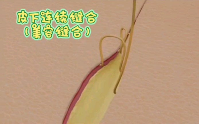 皮下连续缝合(美容缝合)