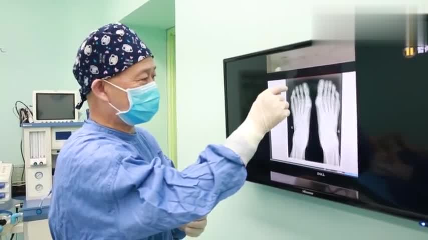 大脚骨手术全过程，其实很轻松
