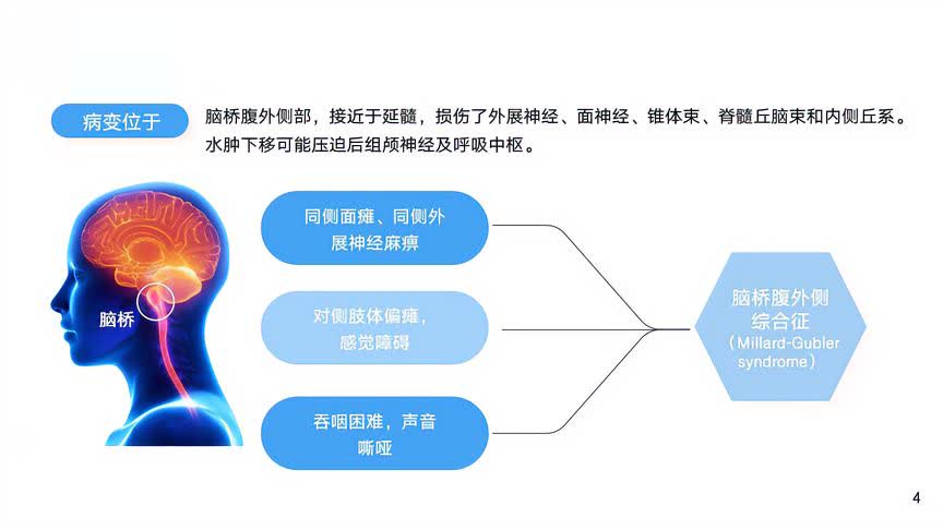桥脑出血护理个案分享PPT