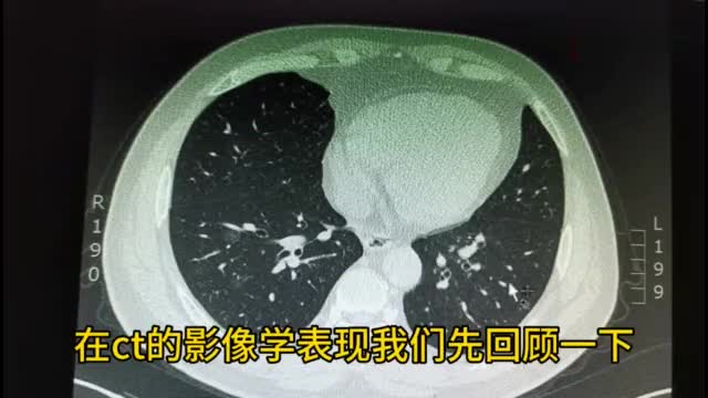 进展期xinguan肺炎CT影像学表现新冠肺炎 肺炎影像学表现