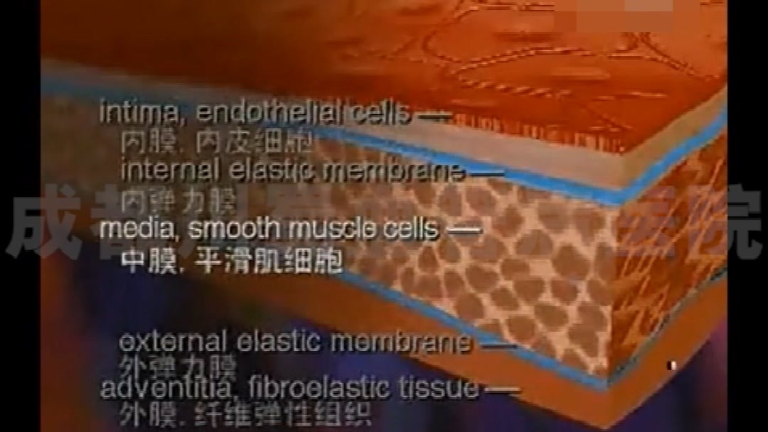 动脉粥样硬化.斑块的形成