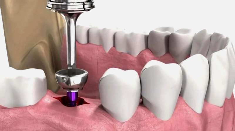 3D演示“种植牙”全过程,真是太神奇了,今天才知道!