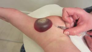 使用液氨请小心!不然这就是被液氮烧伤的后果,脚和和西红柿一样