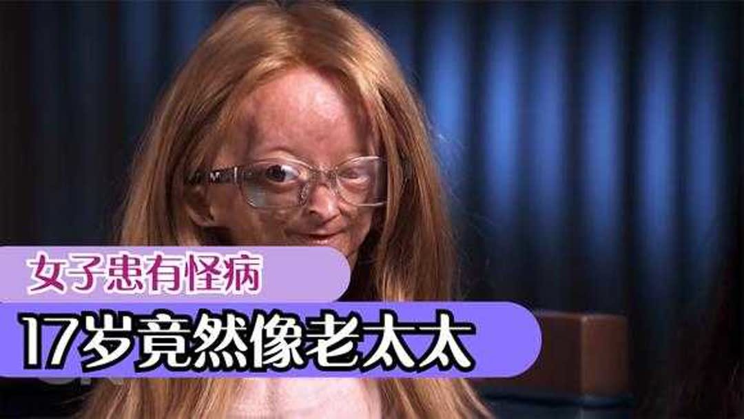 女子患有怪病,出生就迅速变老,年龄只有17岁却像60岁的老太太