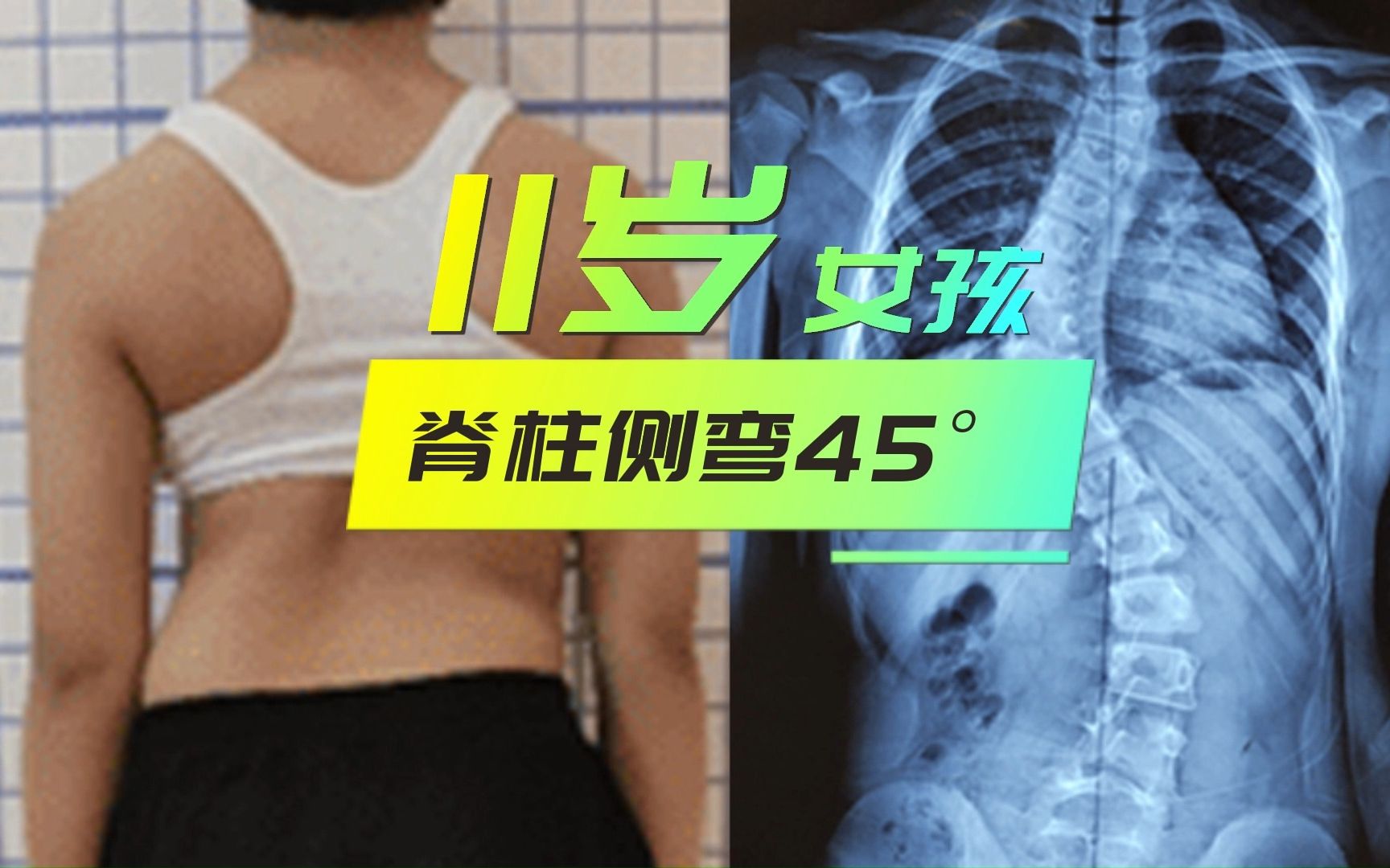 11岁女孩脊柱侧弯45度!脊柱侧弯矫正刻不容缓