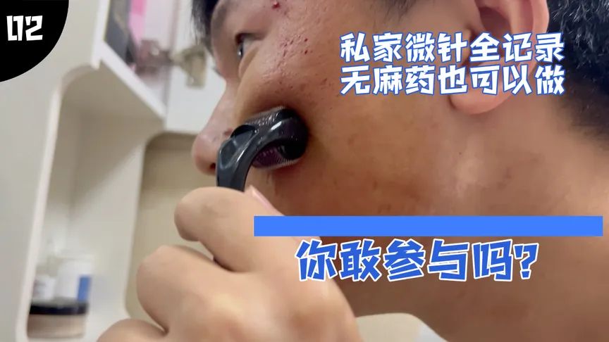 微针超详细过程&恢复全记录|无数针头扎进皮肤真的能磨平痘印吗?