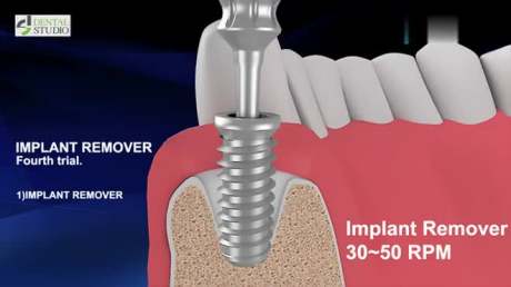 「太实用了」种植牙后种植体断裂取出方法3D演示