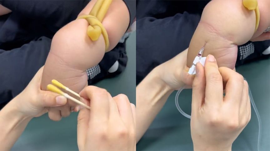 护士姐姐扎针遇到小胖手,连血管都没看见就已经扎稳了:技术真好