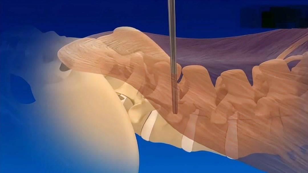 Naton-脊柱微创通道器械使用演示