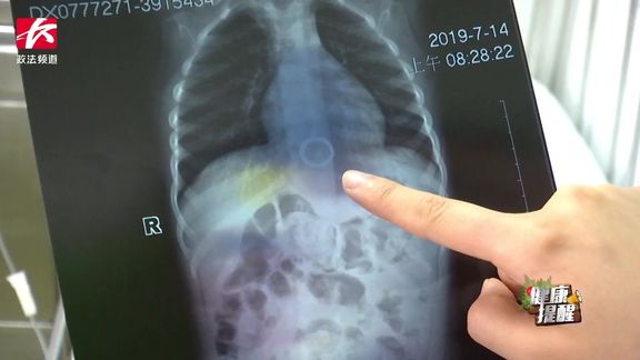 1岁女童误吞戒指反复呕吐进食困难,所幸家人及时取出