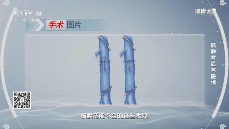 [健康之路]腿肿背后有隐情 如何预防老烂腿