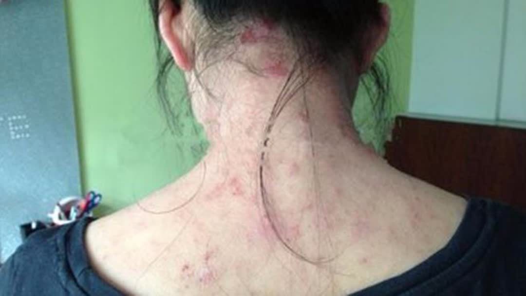 身上长了湿疹怎么办?专家说可以用这种药膏治疗,效果特别好