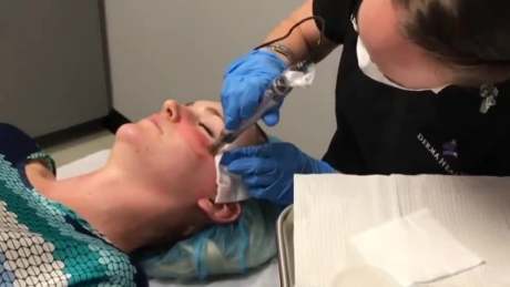 微针美容操作视频,这个出血不是太明显