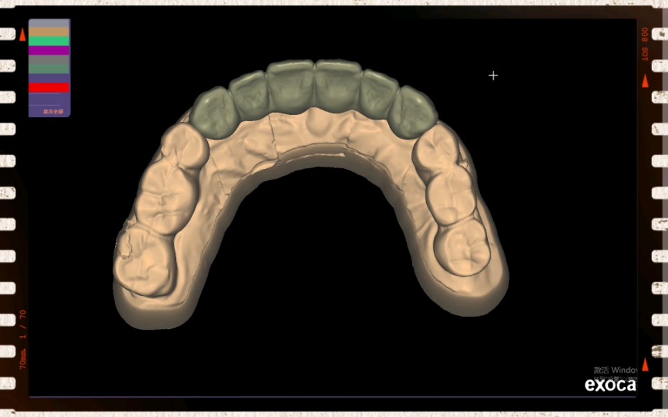 EXO种植基台,更替方法。