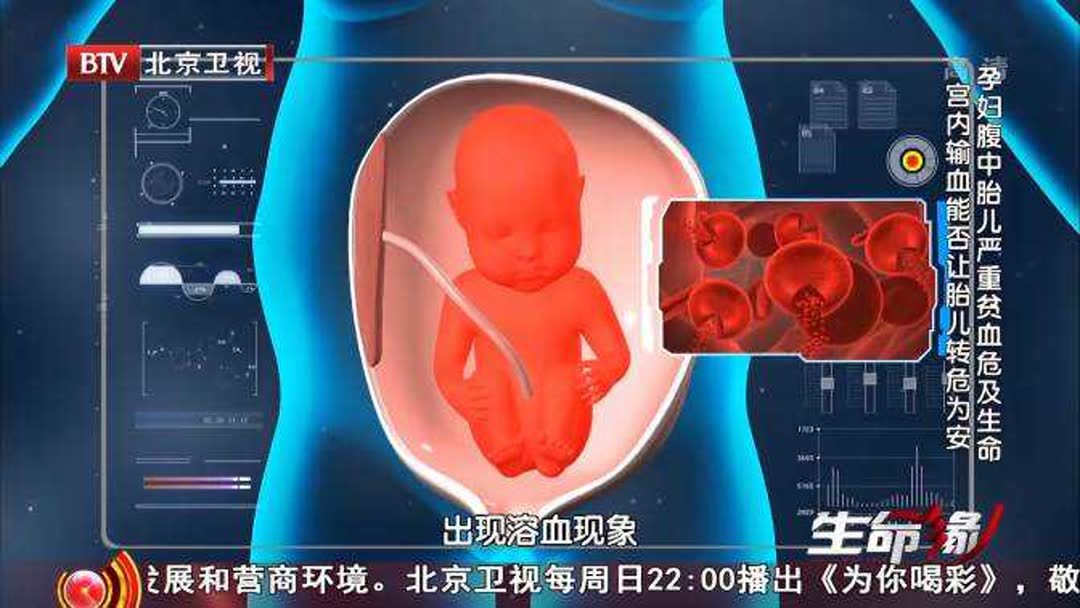 熊猫血孕妇血型异常稀有,腹中胎儿重度溶血,却找不到匹配血型