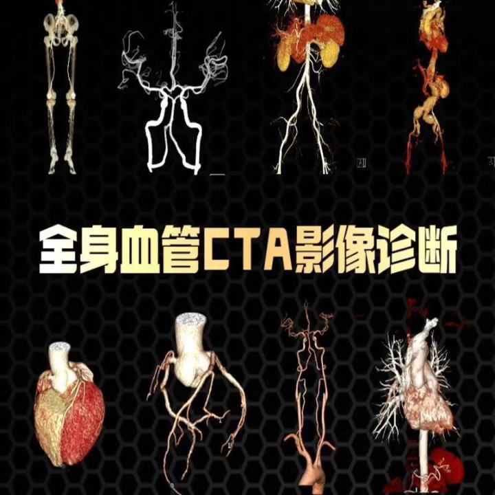 人体全身颈部颅脑冠脉心脏胸部主动脉四肢腹部血管CTA影像诊 鼎湖