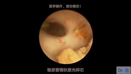 输尿管镜下钬激光碎石