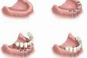 厦门半口种植牙全过程!
