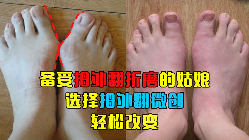 44岁女士为了美,在脚上做了截骨手术,公开拇外翻手术过程