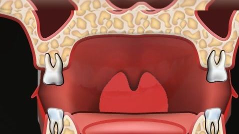 口腔修复学系列教学视频——桩冠2