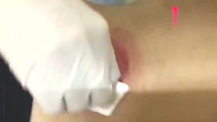放血疗法 一个部位拔这么出这么多瘀血, 是正常的吧