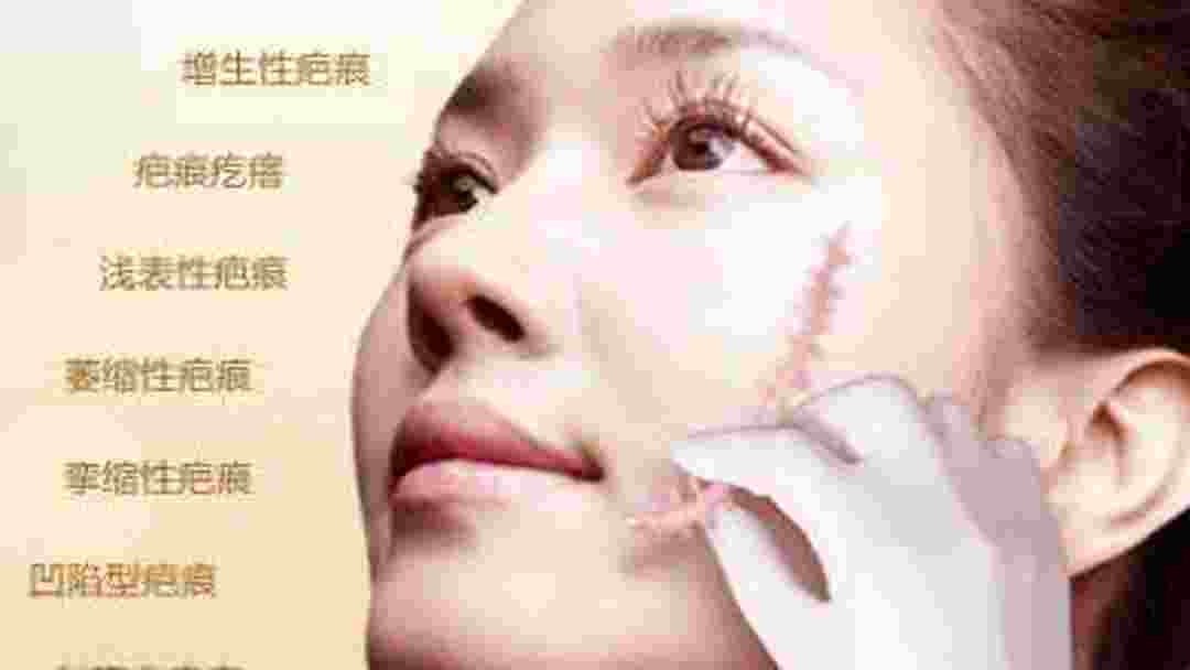 怎样去除脸上的疤印