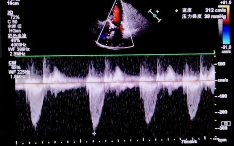 【心超】心脏瓣膜病—中度主动脉瓣狭窄