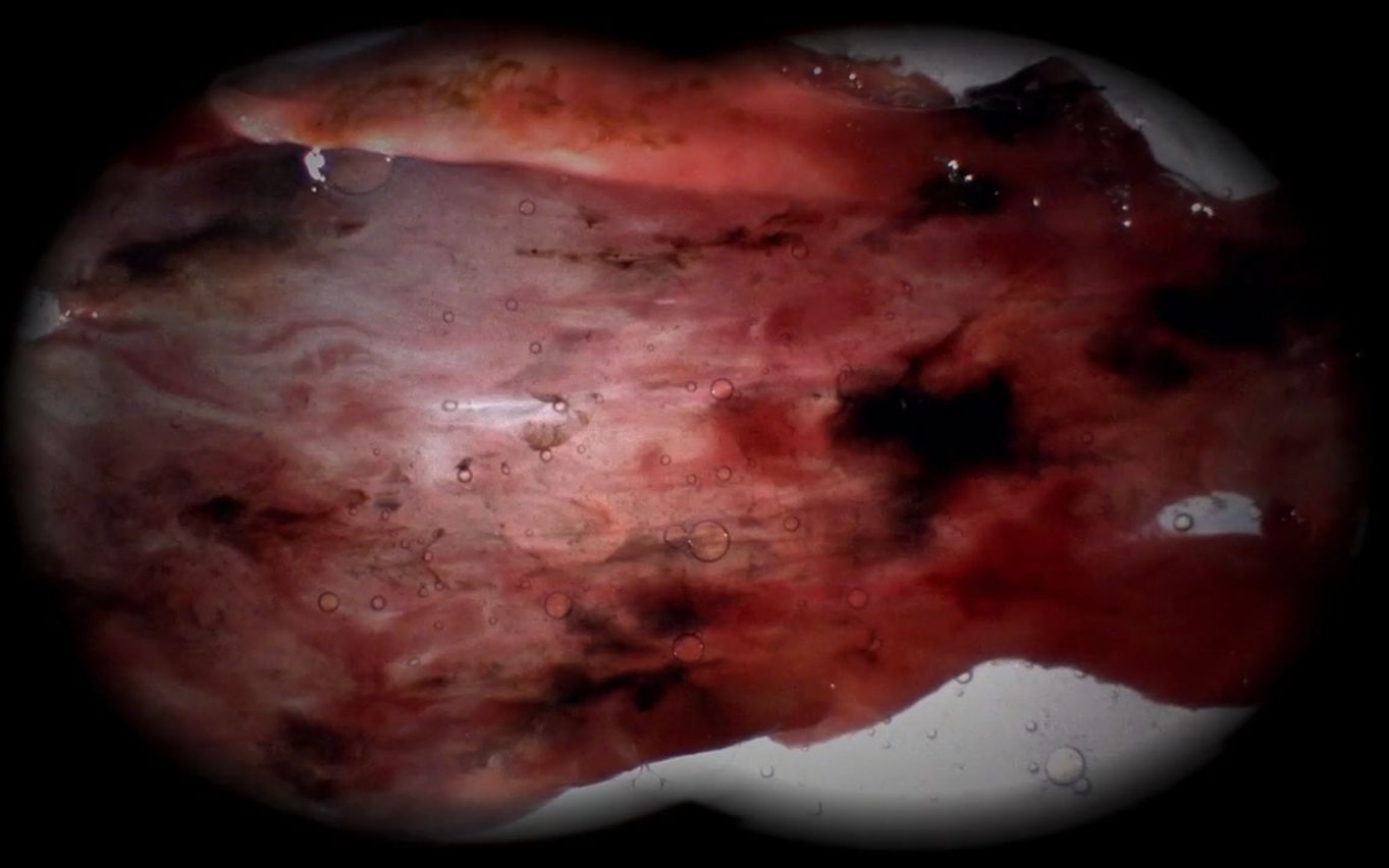 医学推理剪辑-217下-ECD