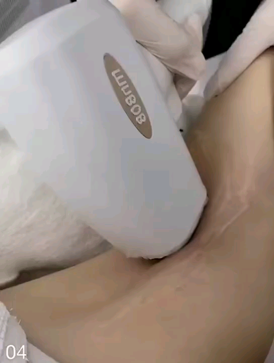 【808nm半导体冰点毛脱‬仪永久脱毛】