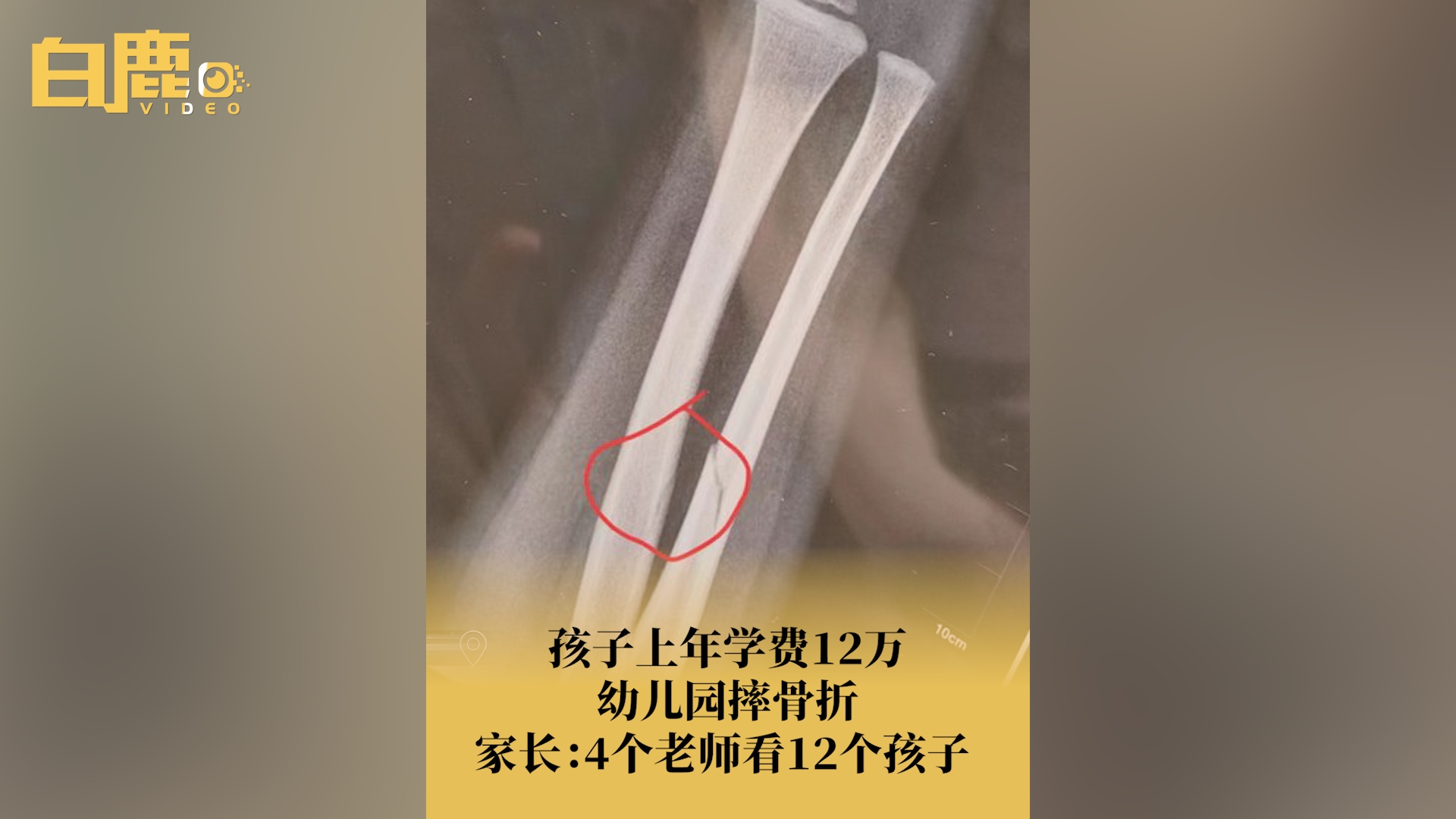 男童名校幼儿园4老师看护下摔骨折