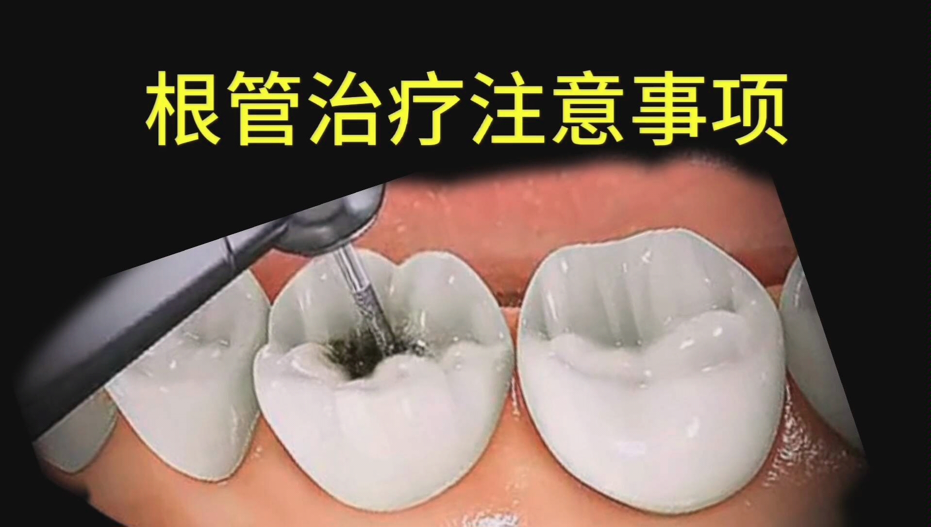 今天给大家带来的是根管治疗后的注意事项。