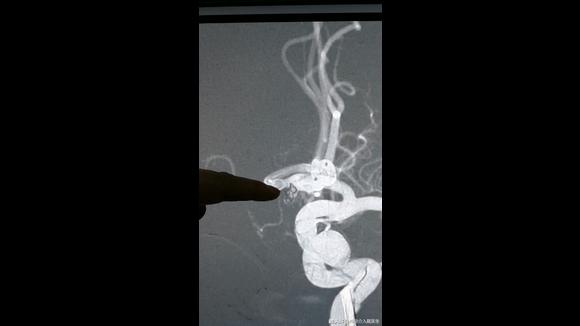 宽颈前交通动脉瘤介入栓塞术之支架释放。