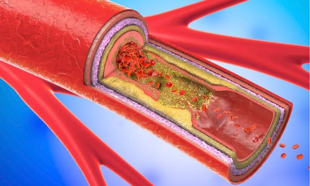 身体出现2个现象,多半是血管堵塞,尽早检查一下