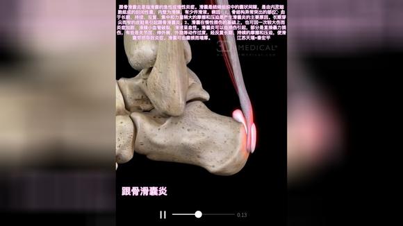 「解剖学动画」跟骨滑囊炎