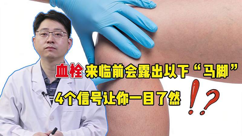 血栓来临前,身体会发出哪些“信号”?听心血管医生说