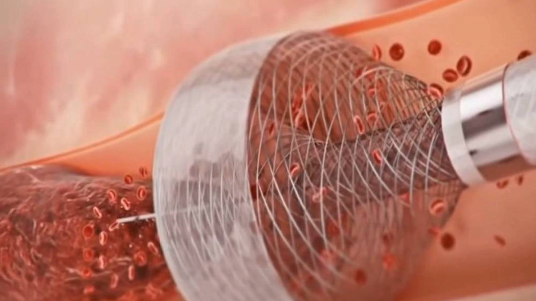 3D动画演示如何去除血栓,看着都觉得疼,这发明太给力了