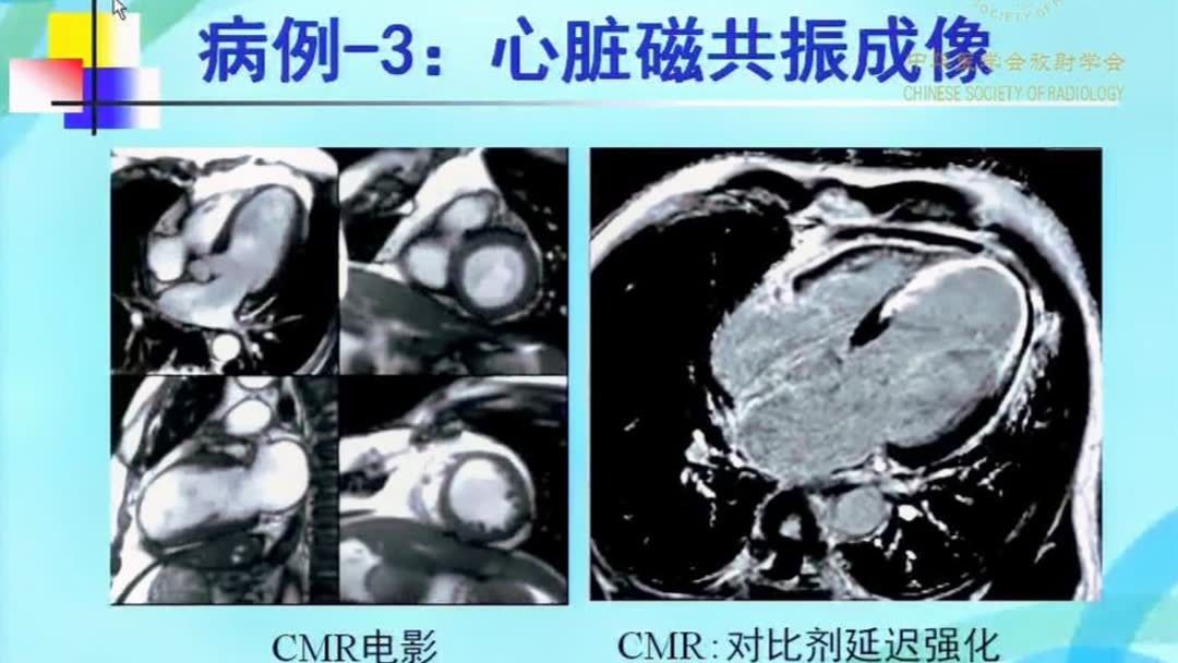 【精品-胸部:心血管】心血管病检查技术的基本特点和优势互补15