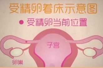 什么是异位妊娠?