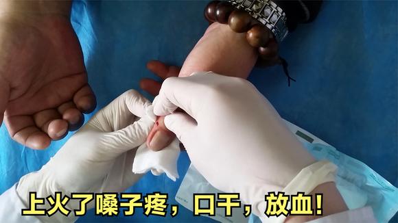 放血疗法:嗓子干疼,咳嗽的时候从指头尖放血治疗