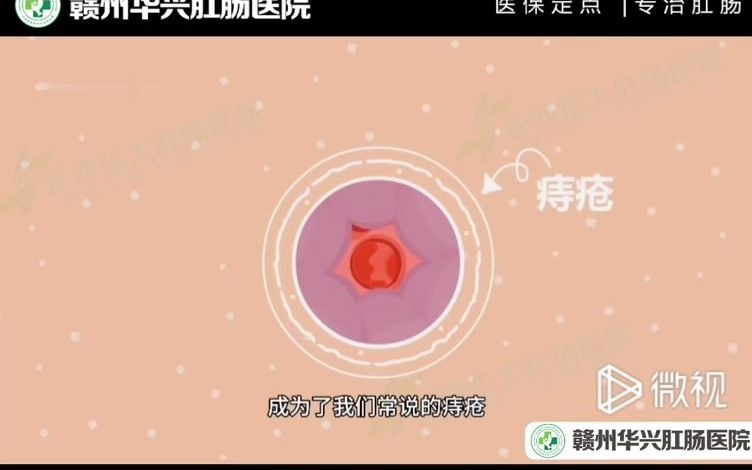 什么是痔疮?痔疮的前身也是肛肠的一部分,多种生活因素导致肛肠内部...