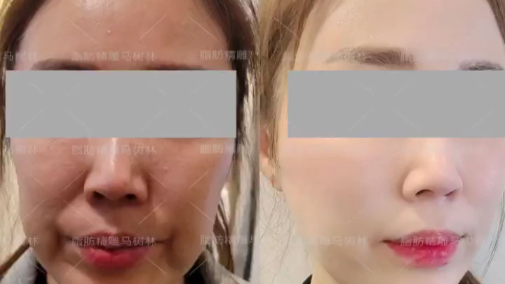 ...面部皮肤松弛下垂造成法令纹明显,两侧有轻微不对称,影响整体颜值。