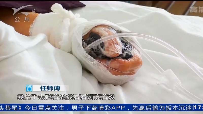 充电电池突然爆炸 老人手掌被炸伤