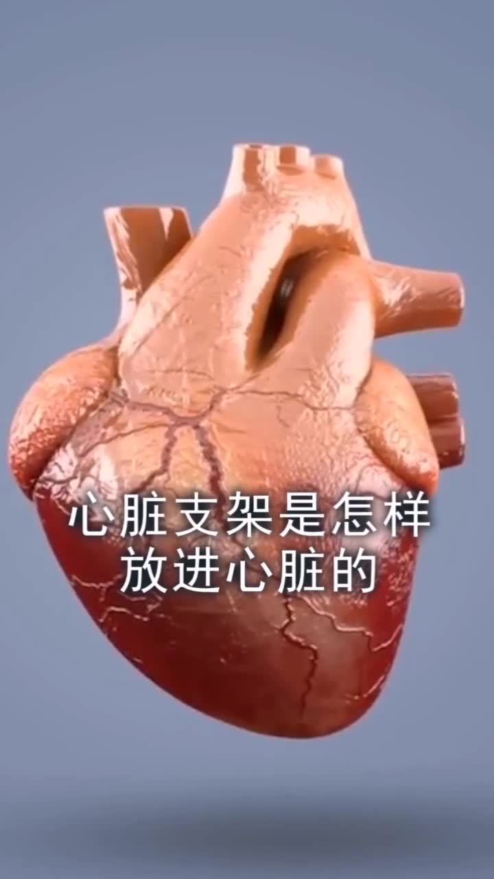 心血管中的支架,是怎么弄进去的?大开眼界了!
