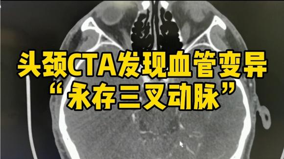 头颈CTA发现血管变异,看看“永存三叉动脉”典型影像!你认识吗