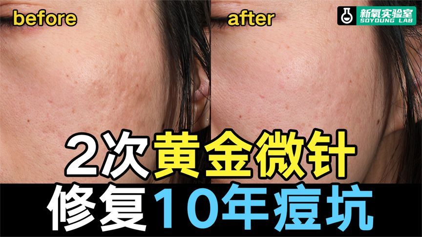 毁容式治痘坑缩毛孔,真人实测黄金微针4个月,真的磨皮了!