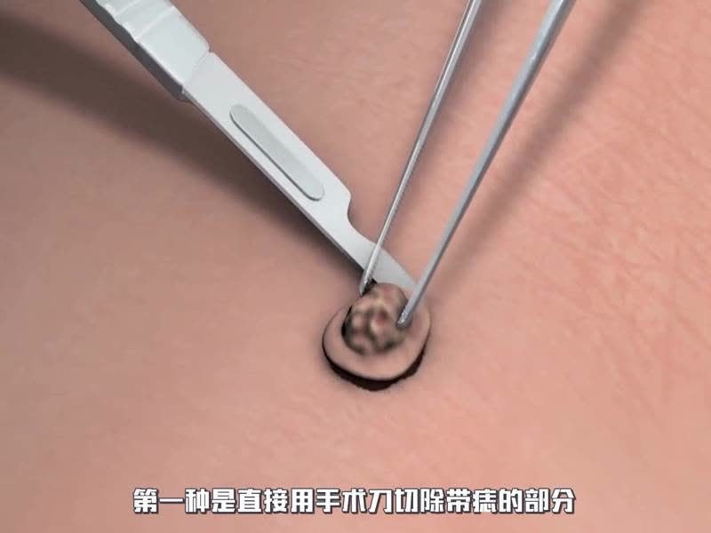 去痣手术怎么做?3D动画模拟过程一目了然,看完你还敢去吗?